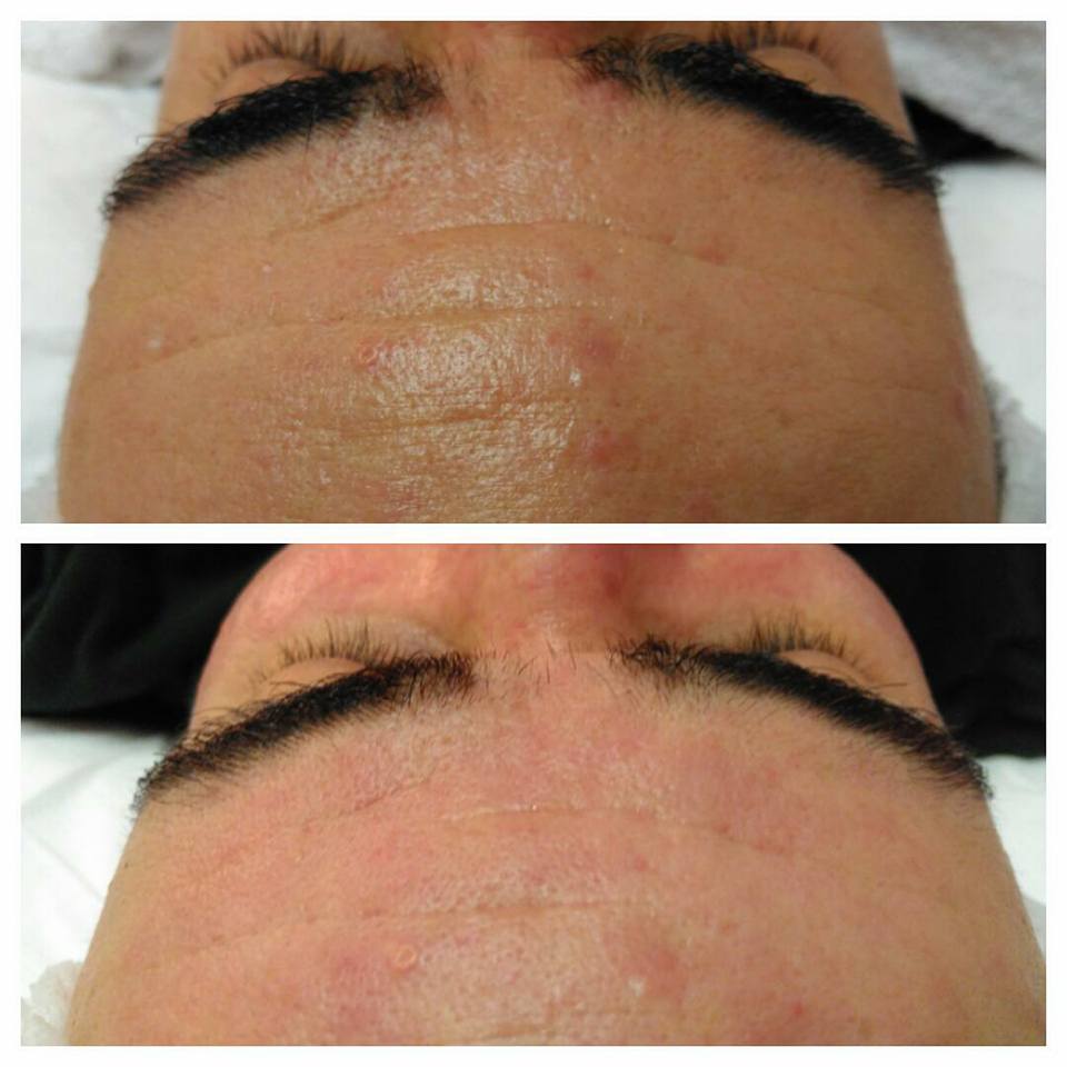 Microdermabrasion for Men