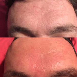 Microdermabrasion for Men - SkinBase™ Facial