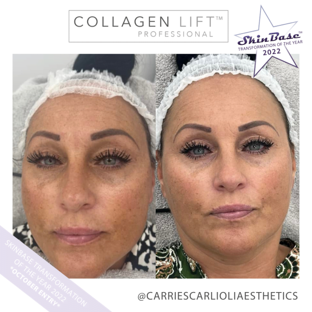 Collagen Lift Winter Transformations