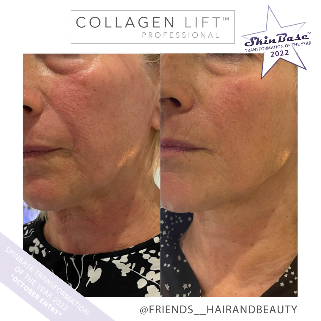 Collagen Lift Winter Transformations