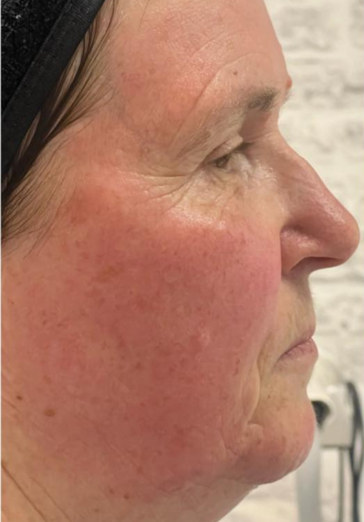Pigmentation: Tips and Treatments for Rejuvenating Your Skin - SkinBase ...
