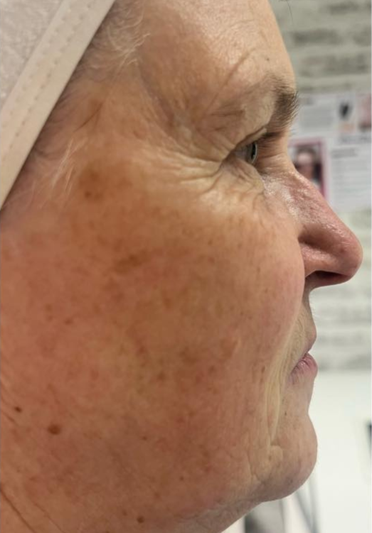 Pigmentation: Tips and Treatments for Rejuvenating Your Skin - SkinBase ...