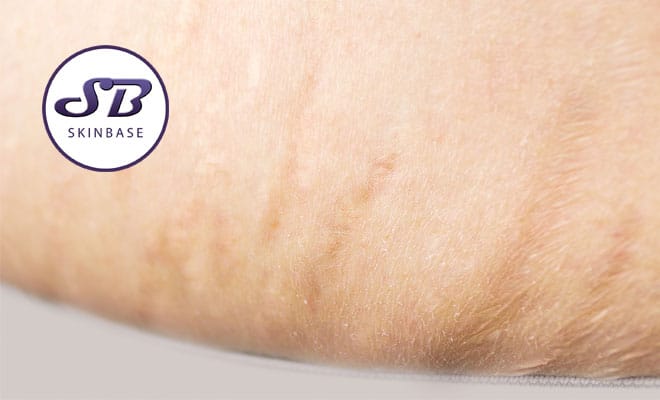 Fantastic Results on Stretch Marks using SkinBase Treatments
