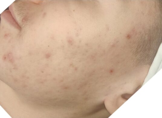 Acne vs pimples: What are the differences and why they matter