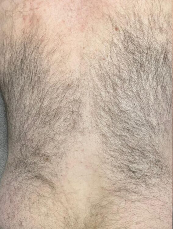 Intense Pulsed Light (IPL) Treatment | SkinBase™ Official UK Site